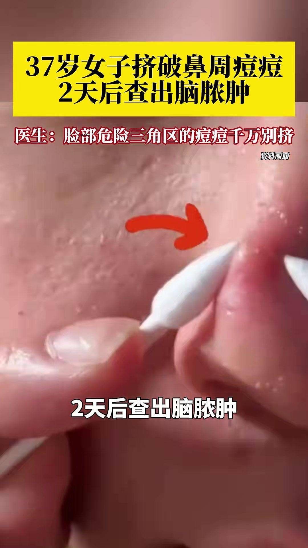这个区域的痘痘别挤!#女子挤破鼻周痘痘2天后查出脑脓肿,医生:脸部...