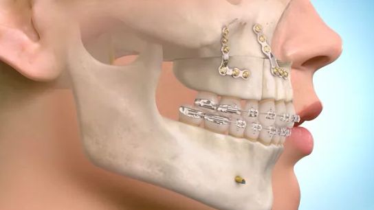 「3D动态」牙齿正畸矫正全过程演示