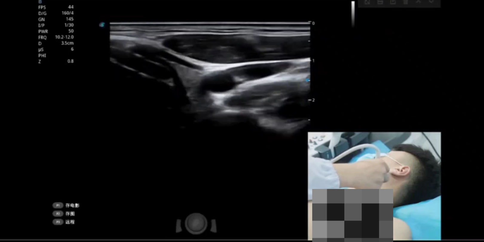 颈部血管超声扫查演示