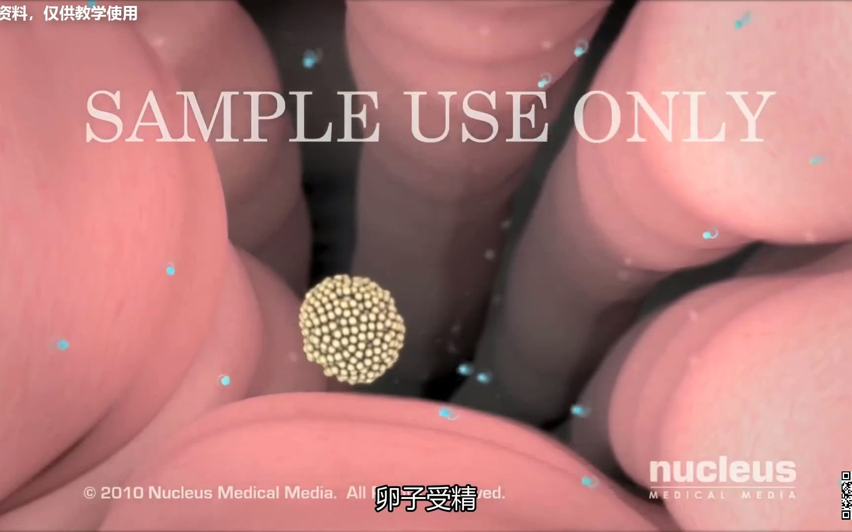 绝育手术之输卵管结扎术Tubal ligation