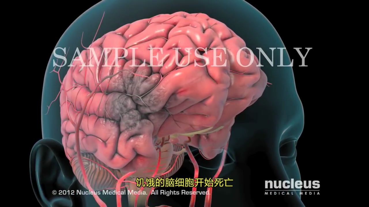 【3D医学动画】出血性脑卒中(中风)
