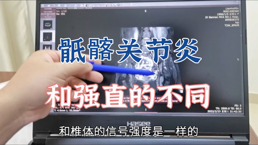 强直性脊柱炎和骶髂关节炎要怎么区分?肖医生讲解成像报告的要点