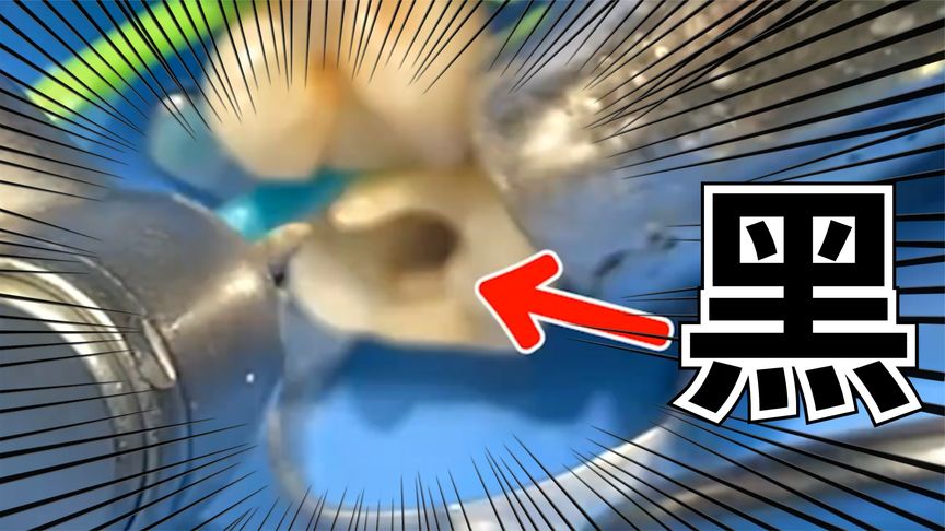 老李给大家分享一例根管治疗病例,科普一下根管治疗的注意事项