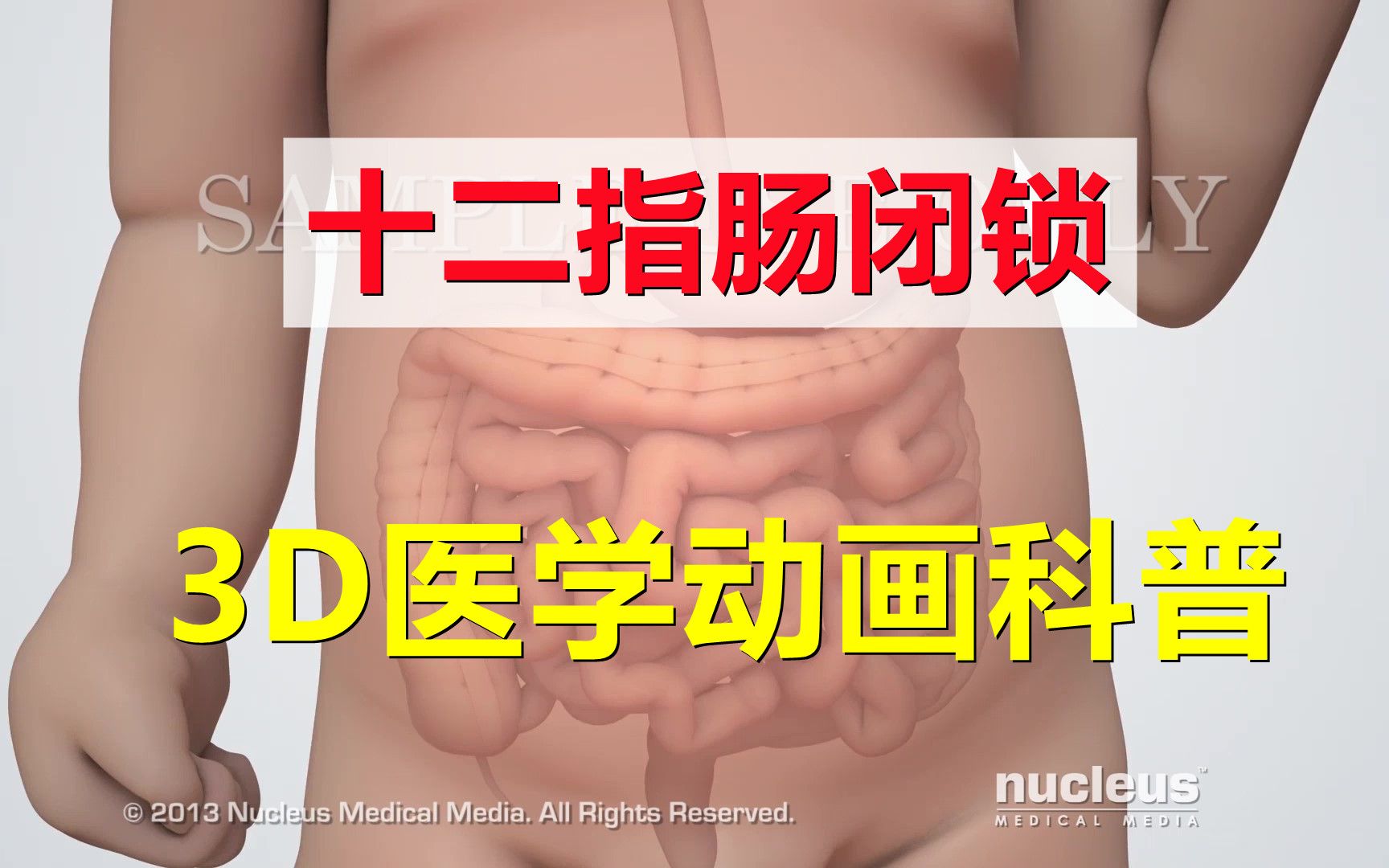 【3D医学动画科普】十二指肠闭锁(中英双语字幕)