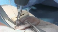 大鼠股骨截骨术及外周可调固定器节段性缺损模型(rat bone defect mode)