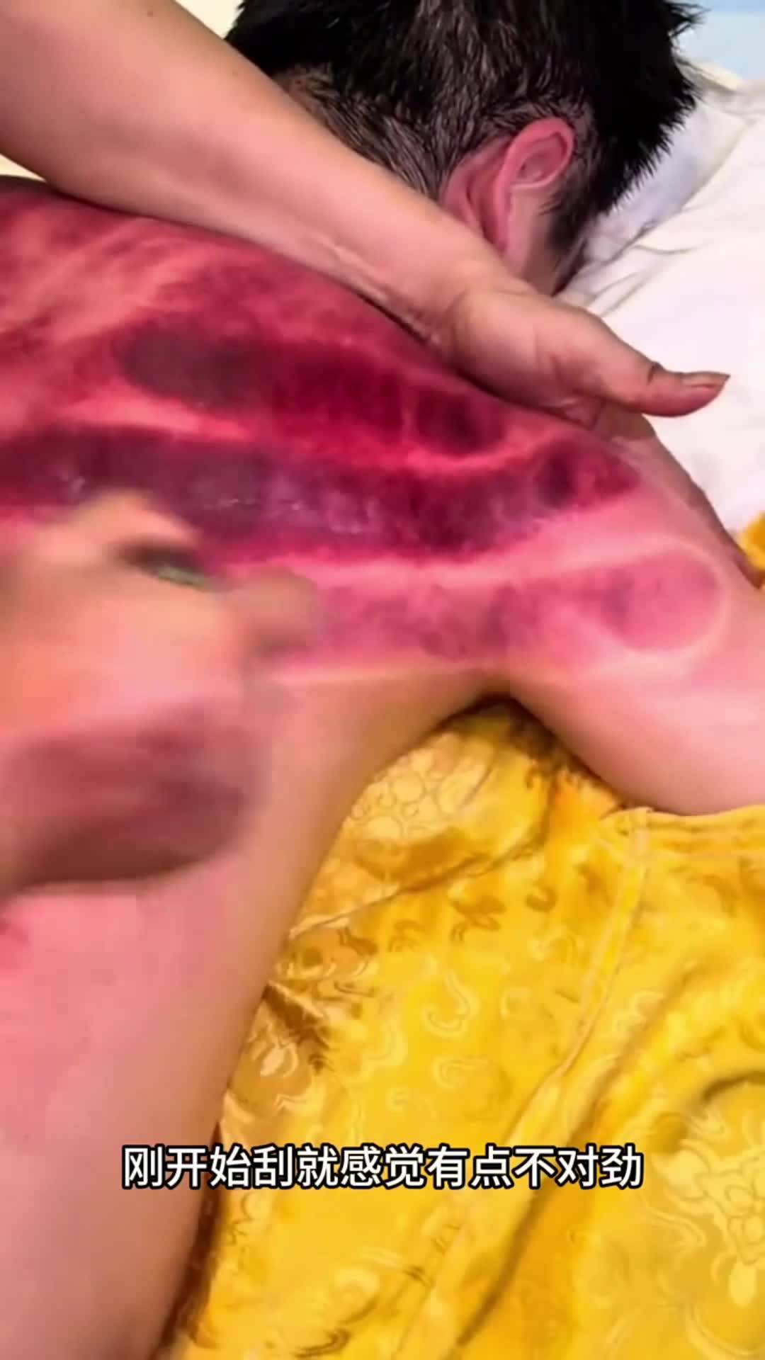 这刮痧下手也太狠了,刮完得脱一层皮