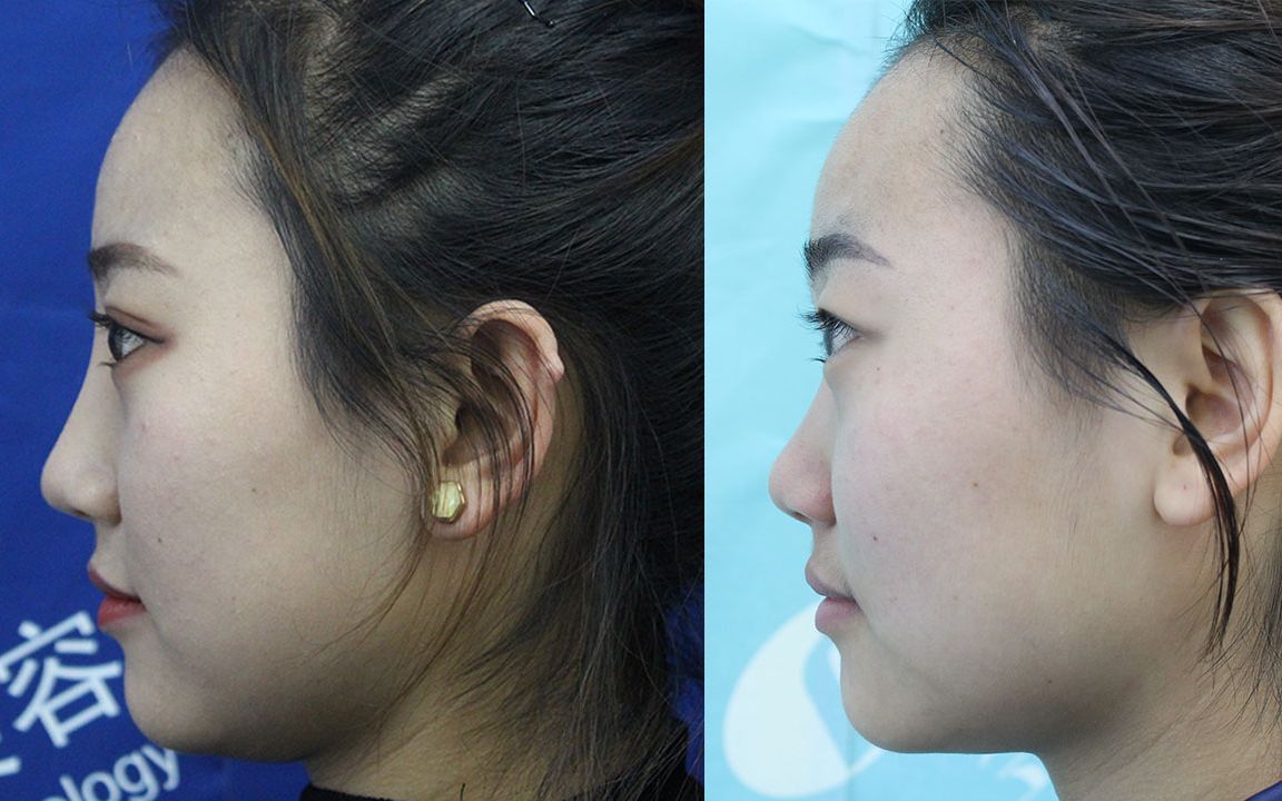 00后耳软骨硅胶隆鼻全过程记录,你想知道的细节全在里面