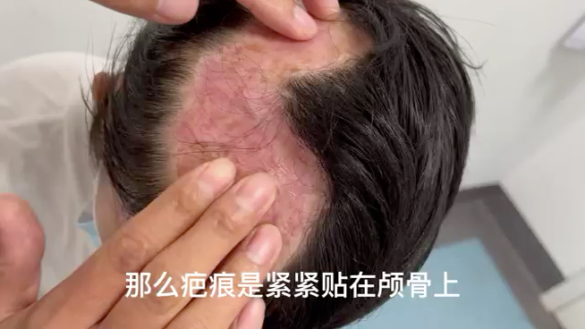 烧伤后头皮瘢痕该怎么治疗?