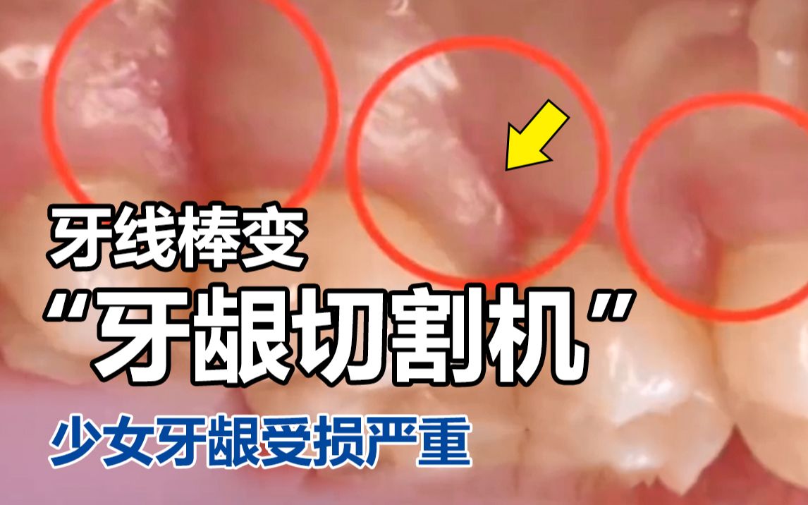 【口腔大热搜】警惕! 少女错误使用牙线棒,秒变“牙龈切割机”牙龈...