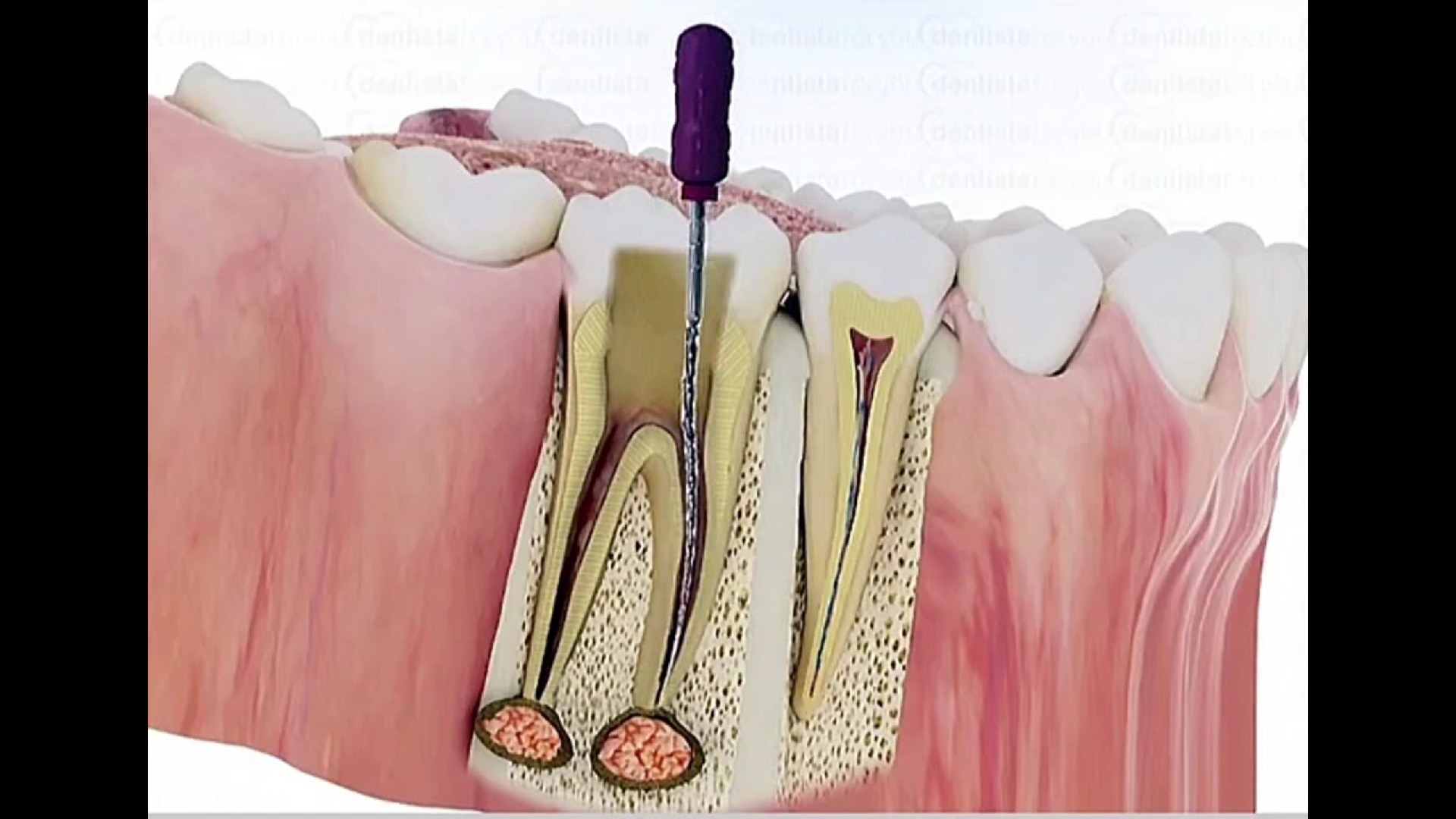 根管治疗3d动画演示