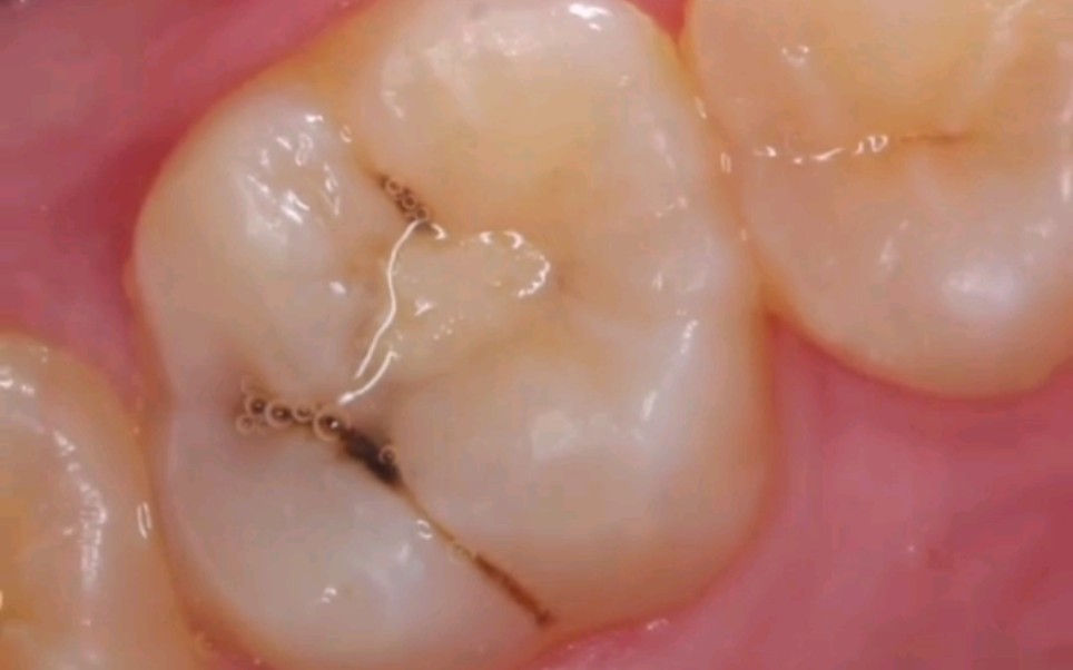 有蛀牙但不疼也要补牙吗?牙齿没有修复功能,又是人体不可缺少的组织...