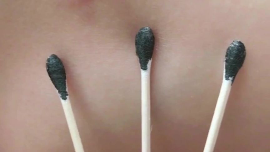 疤痕如何去掉 就用这个方法