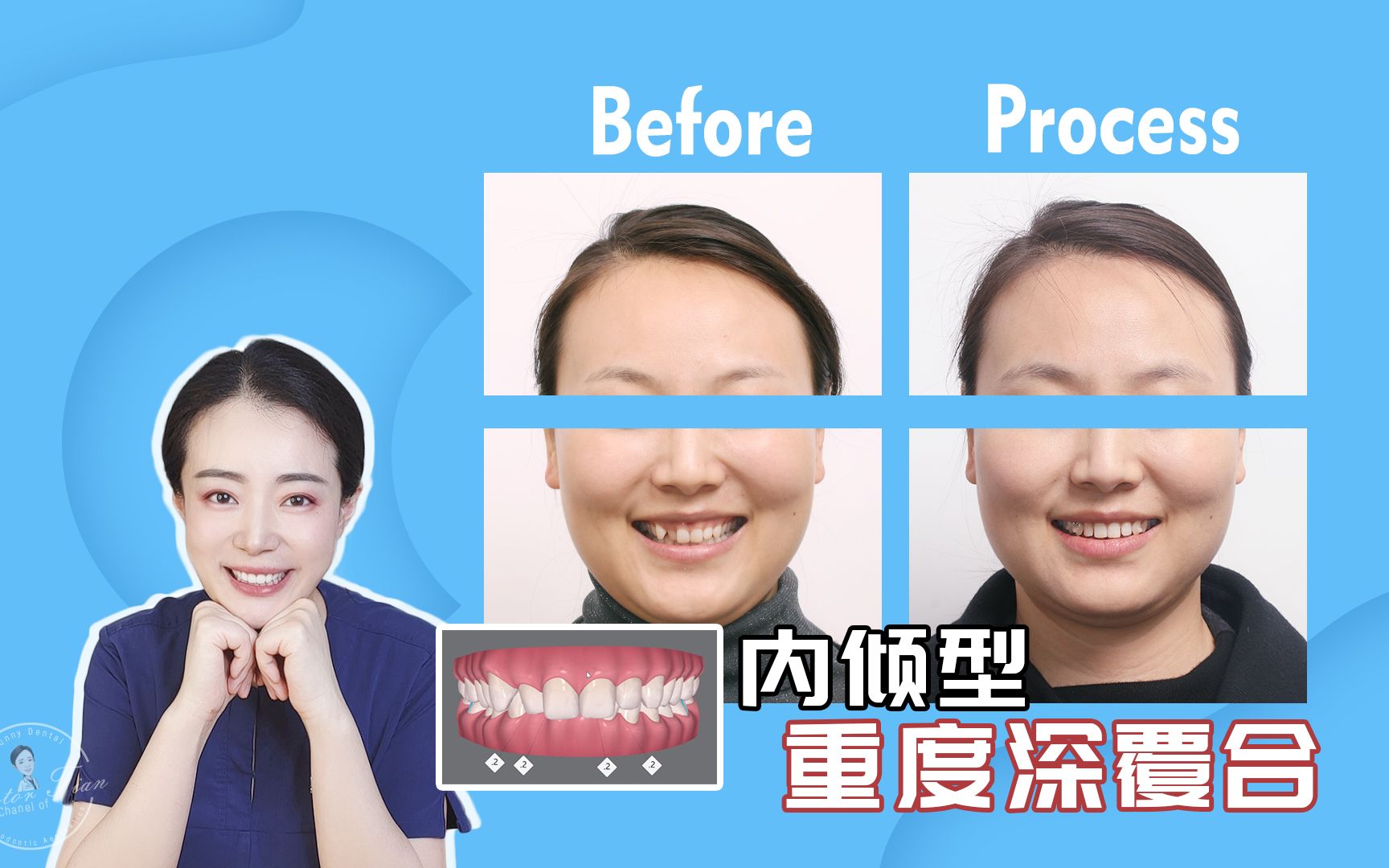 北大正畸博士的隐适美方案笔记丨上牙挡住下牙,内倾型深覆合是如何...