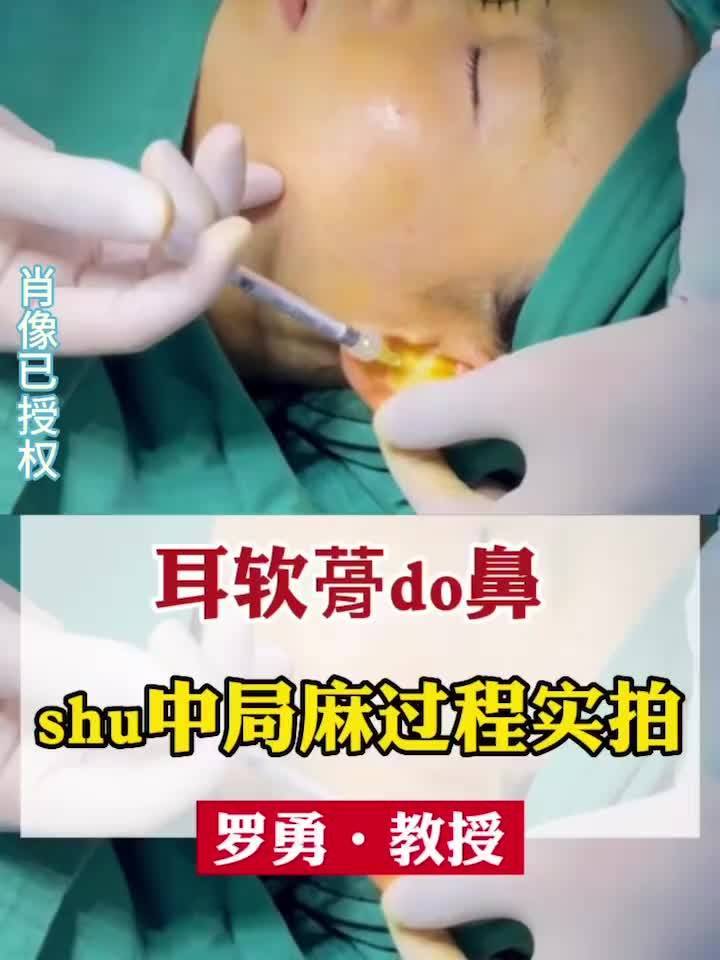 耳软骨隆鼻,术中手术过程实拍!
