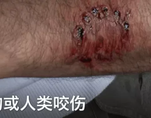 急救: 动物或人类咬伤 - 学习急救