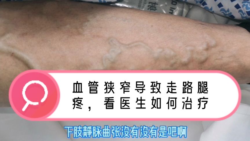 走路腿疼,原来是血管狭窄导致的缺血,医生给植入支架后好转