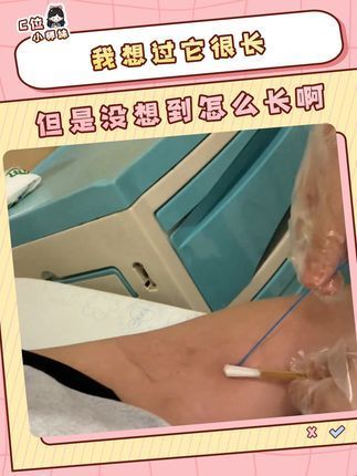 我想过它很长、没想到怎么长~#picc #万万想不到 #震惊 #医学科普