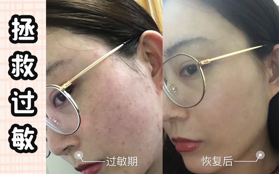 【推荐篇】过敏这件事(二)