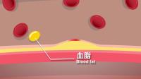 医疗类_“动脉硬化”动画展示