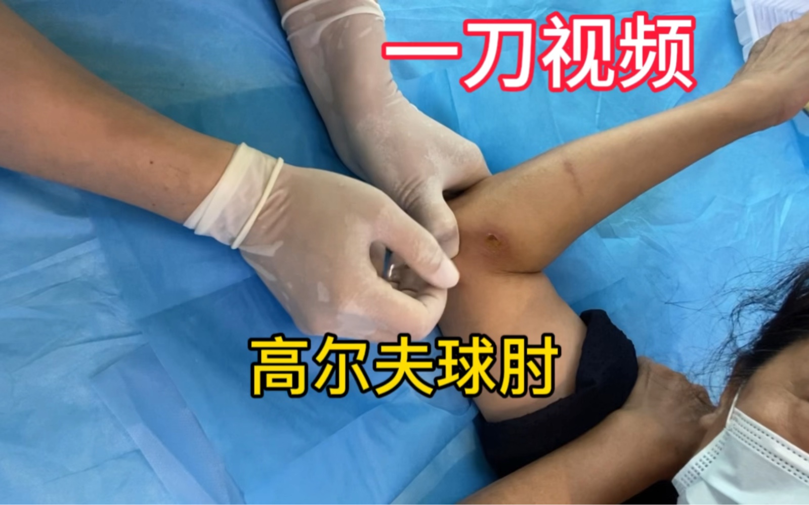 高尔夫球肘(肱骨内上髁炎)微创手术:一刀视频