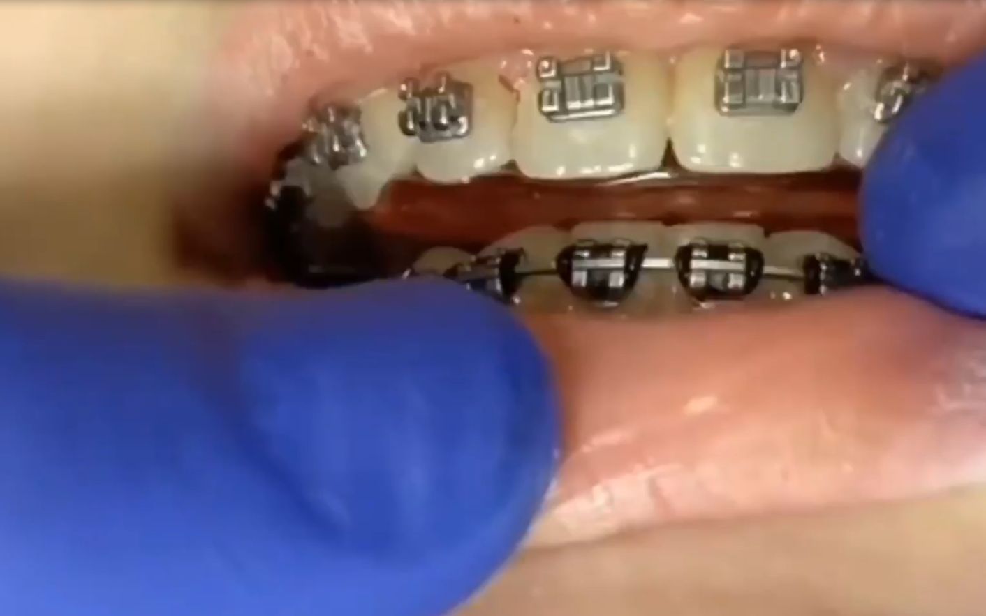 牙齿安装扩弓器全过程