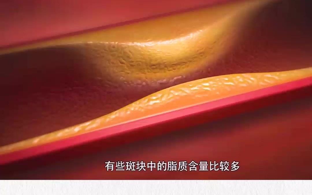 急性心肌梗死介入手术过程
