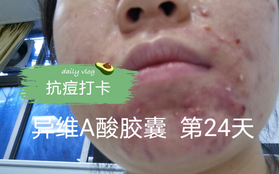 ...尖/又开始淋巴结炎/还牙龈肿痛!我真的伤痕累累啊【异维A酸】第24天