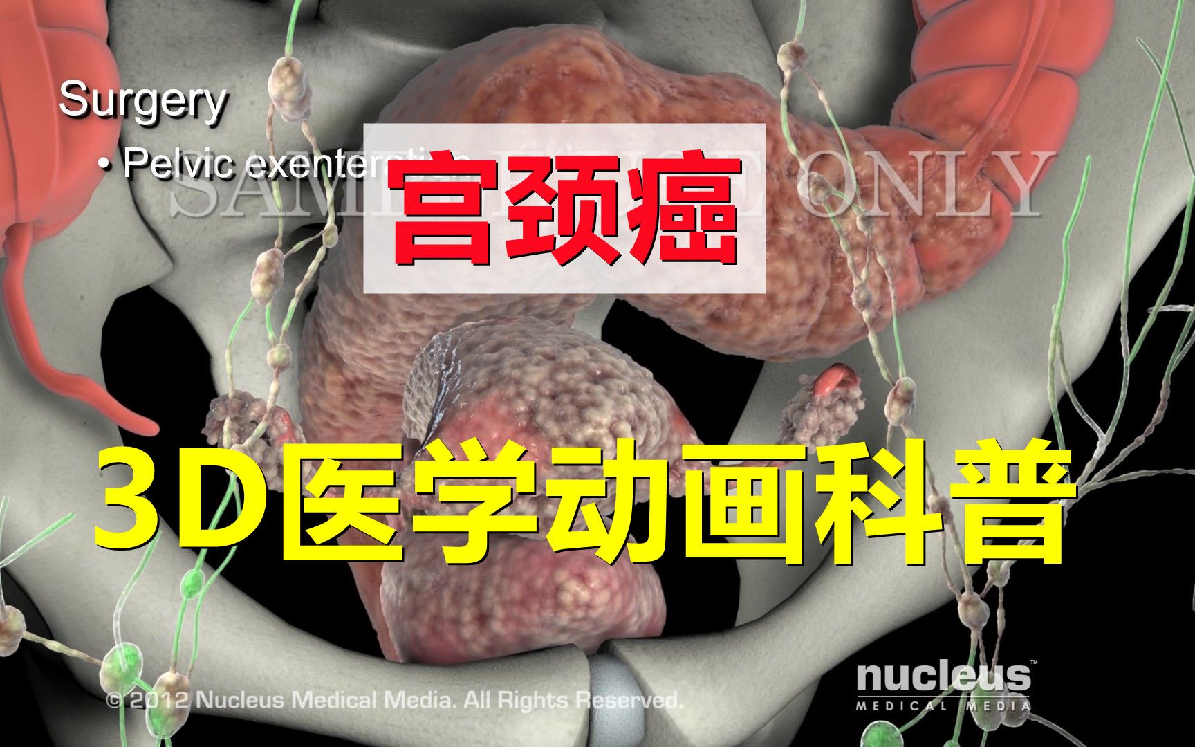 【3D医学动画科普】宫颈癌(中英双语字幕)