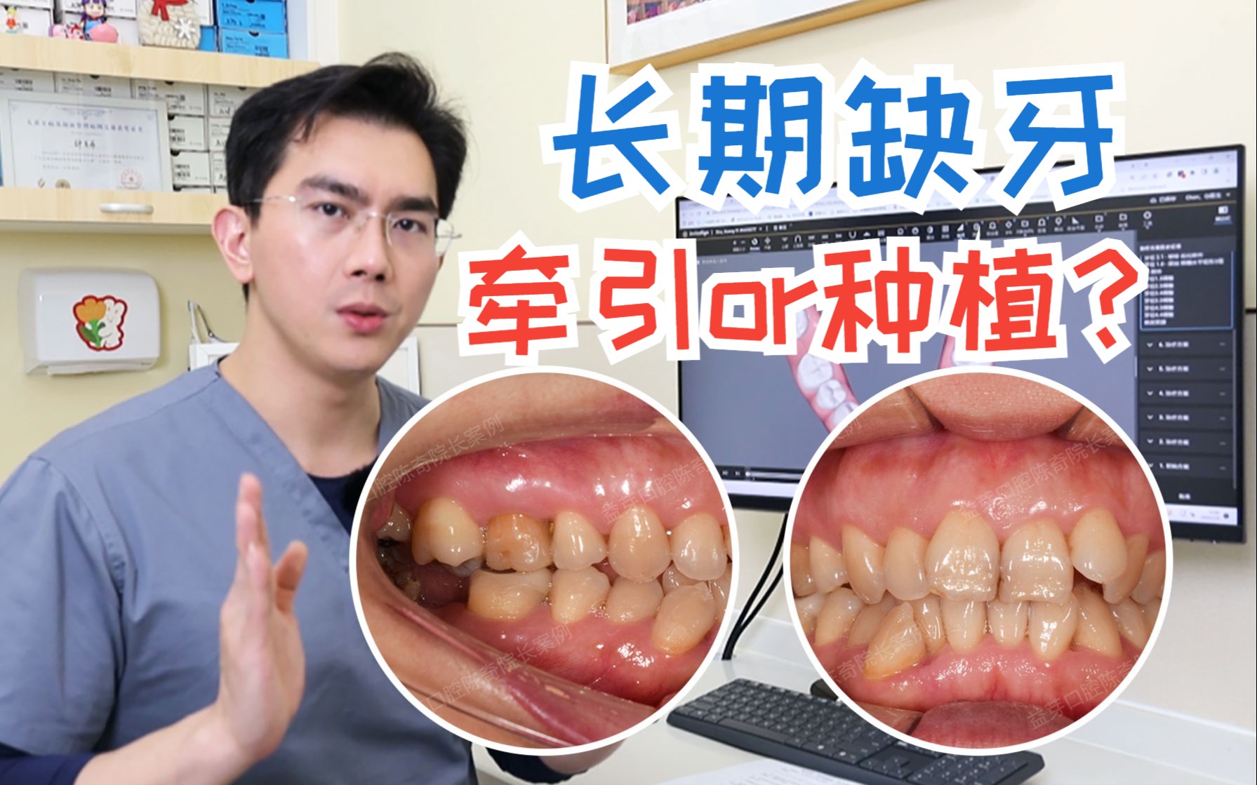 长期缺失大磨牙,是选择正畸牵引智齿还是做种植牙?