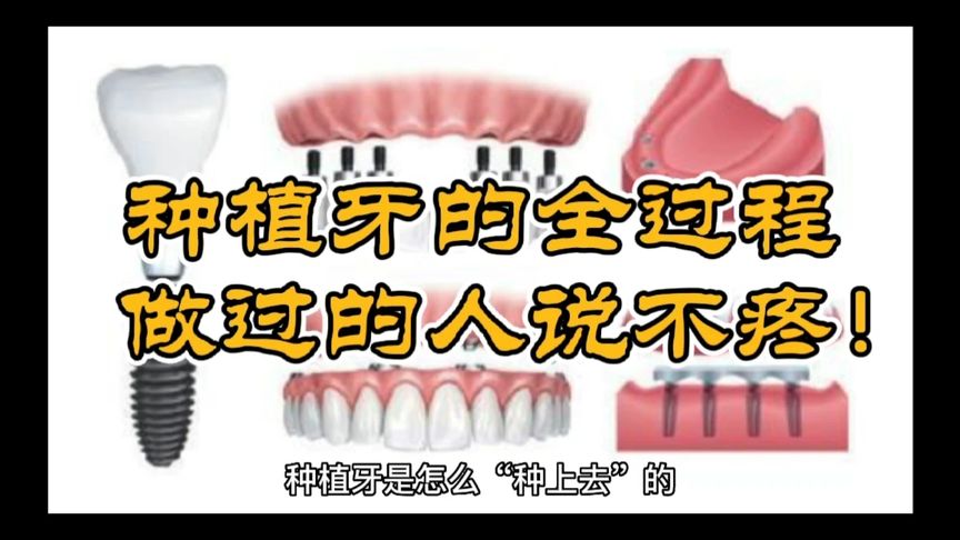 种植牙的全过程,做过的人说不疼!