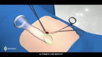 我在【康基精品】一次性套管穿刺器使用方法步骤截了一段小视频