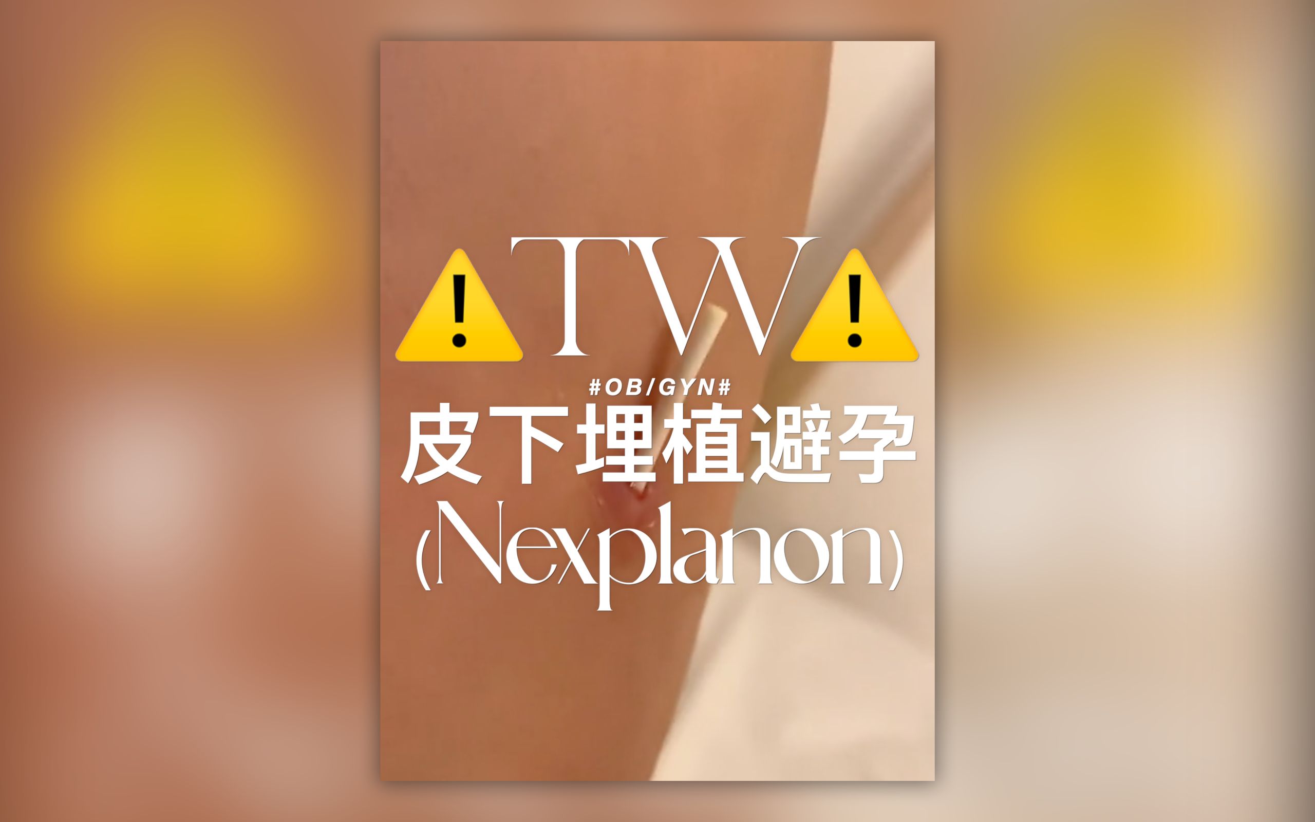⚠️ TW ⚠️ 皮下埋植避孕棒 (Nexplanon)从皮肤下面跑了出来