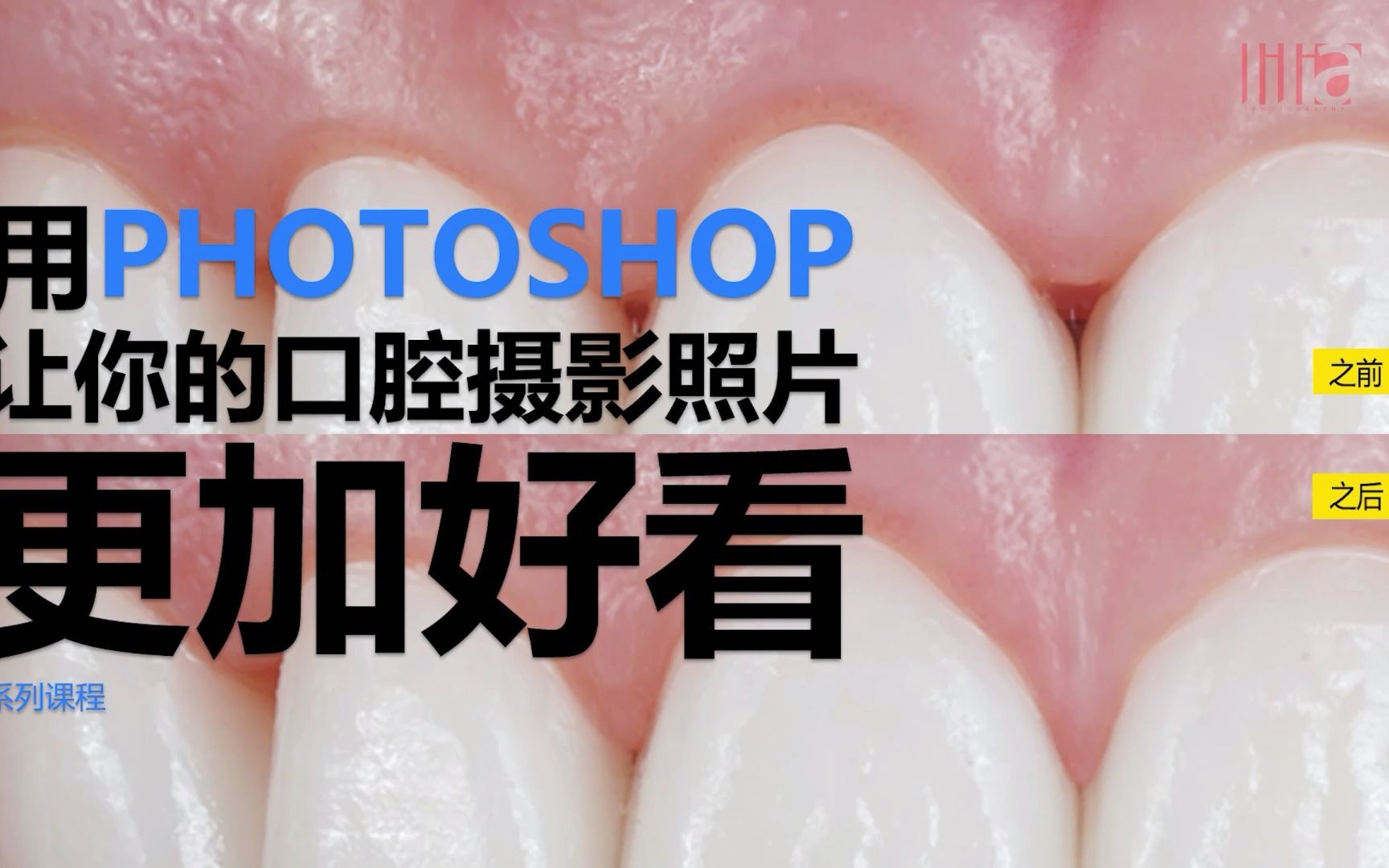 系列课程-修补牙龈大法