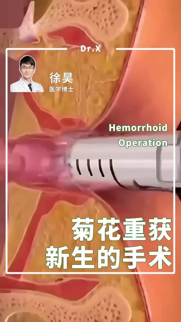 痔疮的手术治疗,有困扰的朋友们注意了!