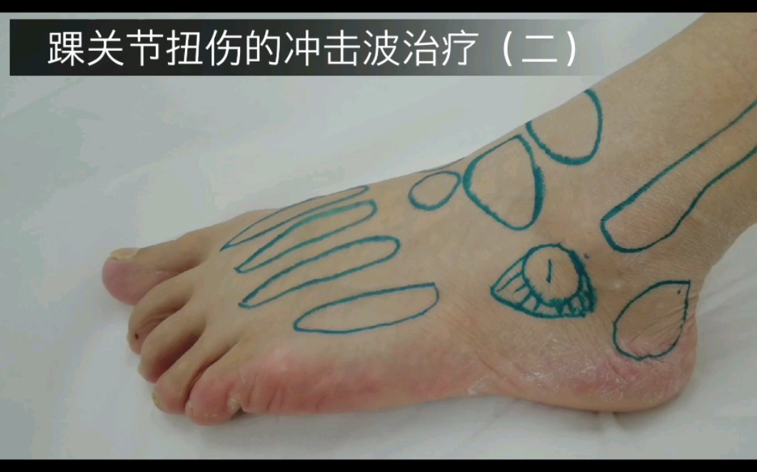 踝关节扭伤的冲击波治疗(二)