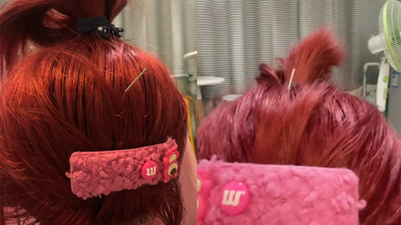 女子针灸结束5小时后,发现头顶还有针没拔,原因令人哭笑不得!