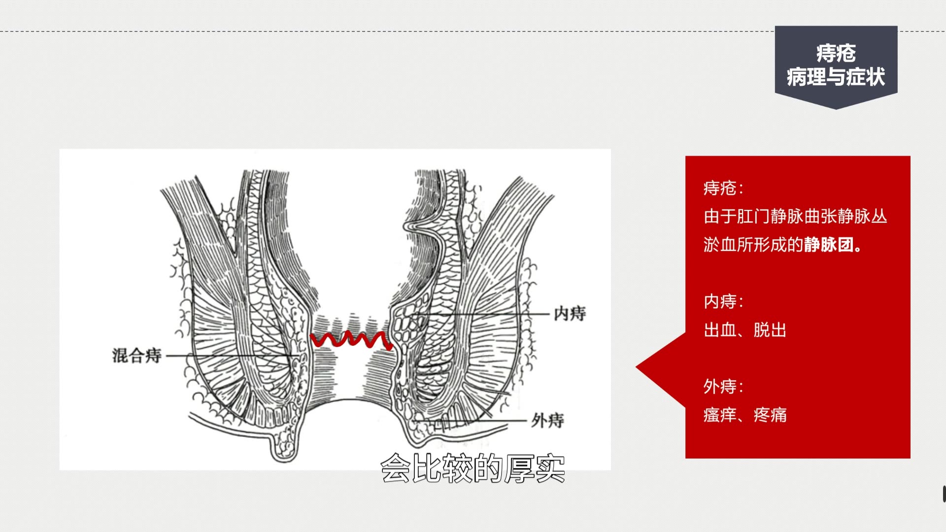 这是一条关于痔疮的视频