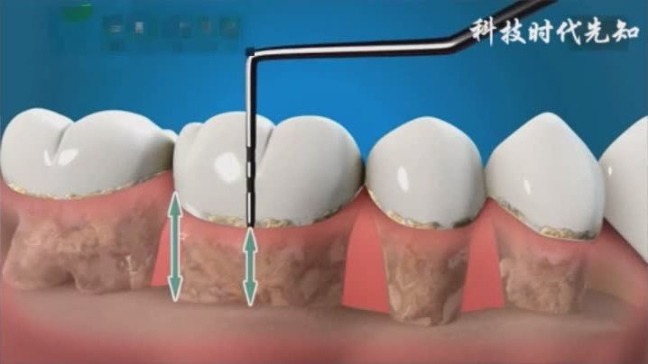 龈下刮治术,年轻的时候就要多关心自己的牙齿健康