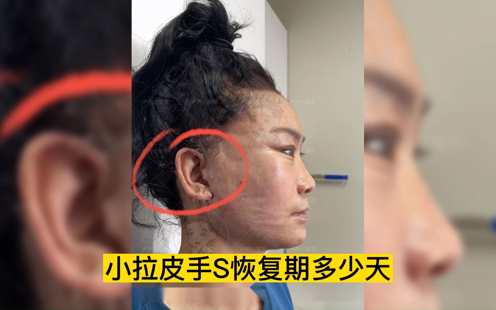 小拉皮手术恢复期多少天