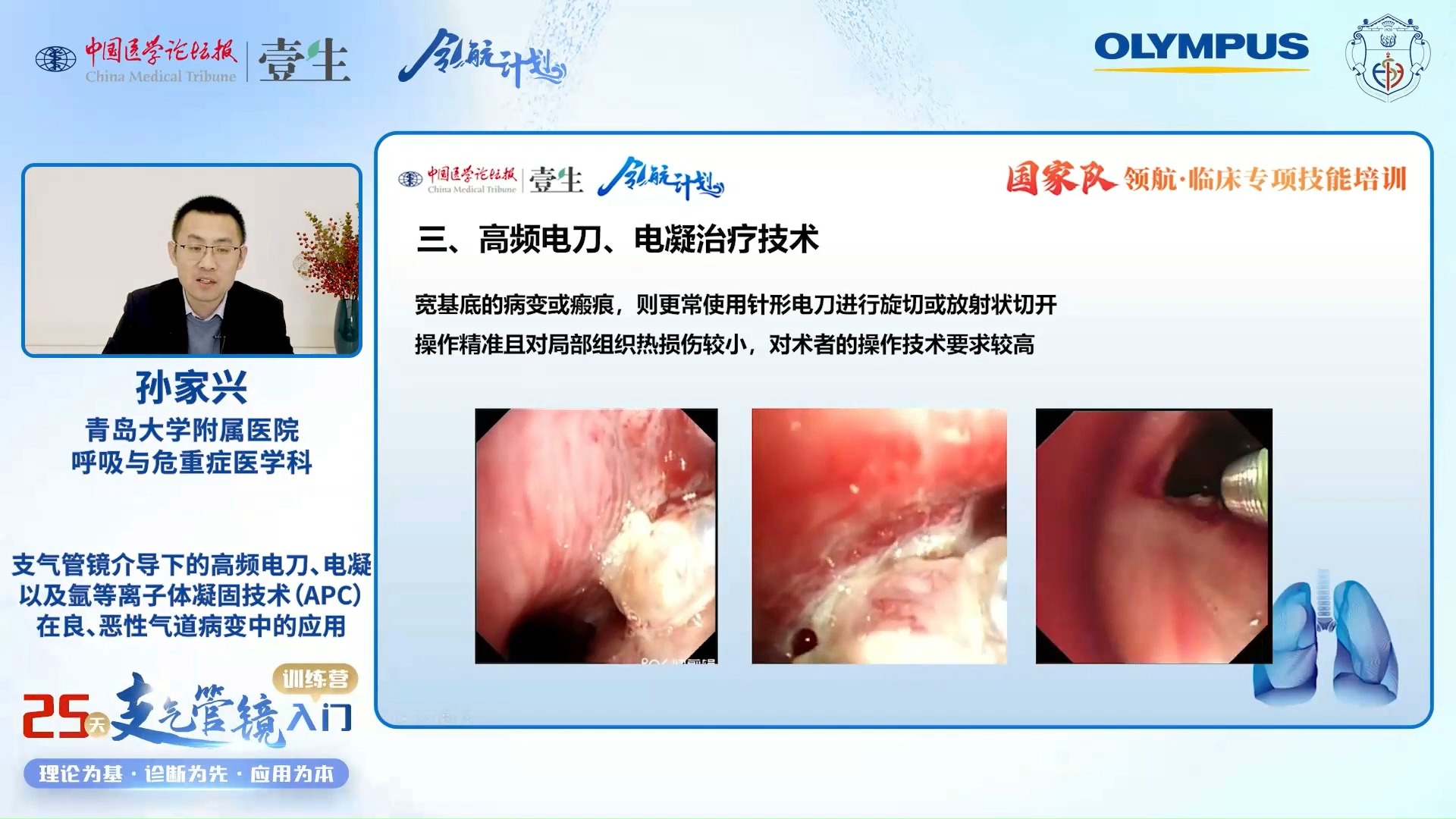 支气管镜介导下的高频电刀、电凝以及氩等离子体凝固技术(APC)在良...
