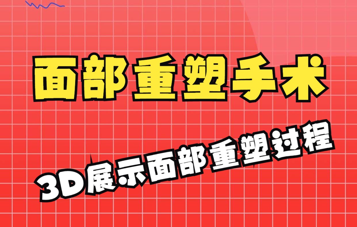 变性后如何重塑面部,3D动画展示手术过程!
