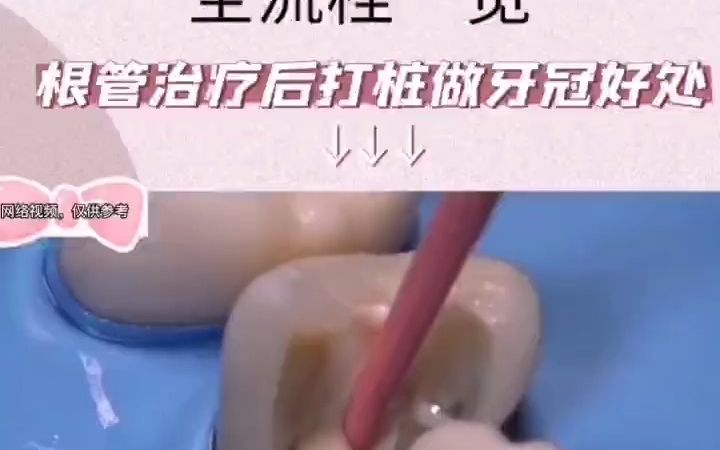 根管治疗后打桩做牙冠效果好吗?