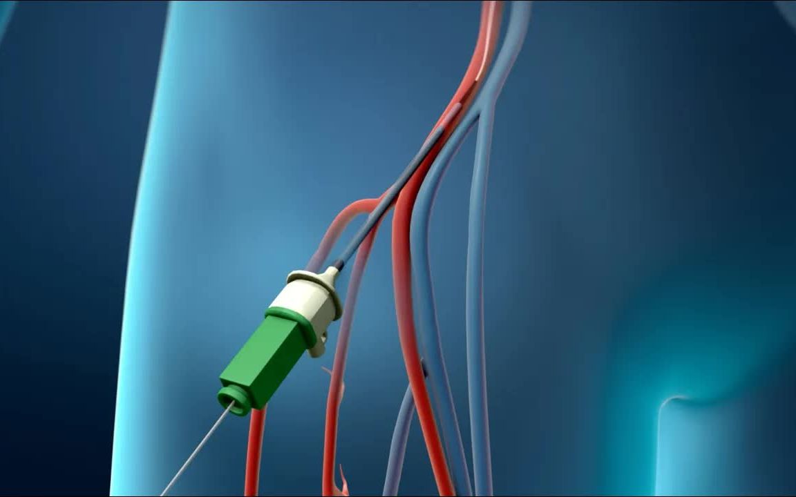 冠状动脉成形术(股动脉入路)