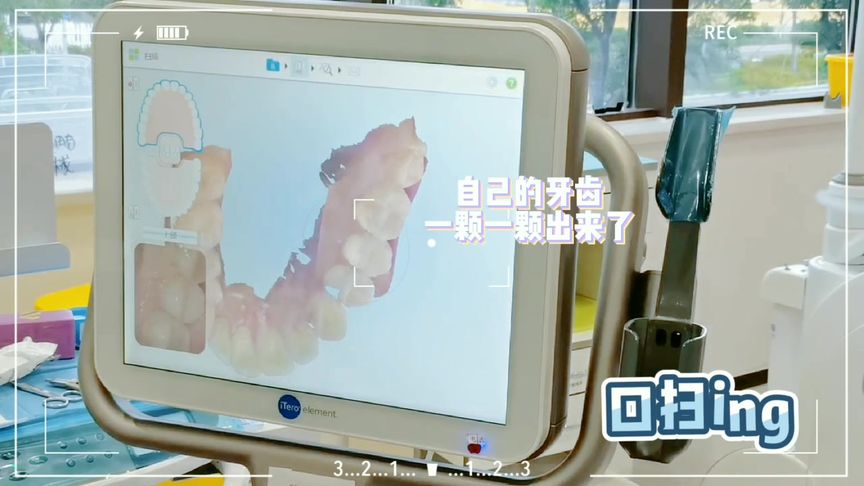 实时展示牙齿模型,你体验过口扫吗?#正畸 #牙齿矫正 #整牙