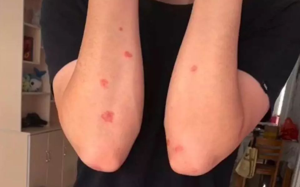 初中生患皮肤病自卑,出门用衣袖遮挡反被母亲指责,医生看不下去了