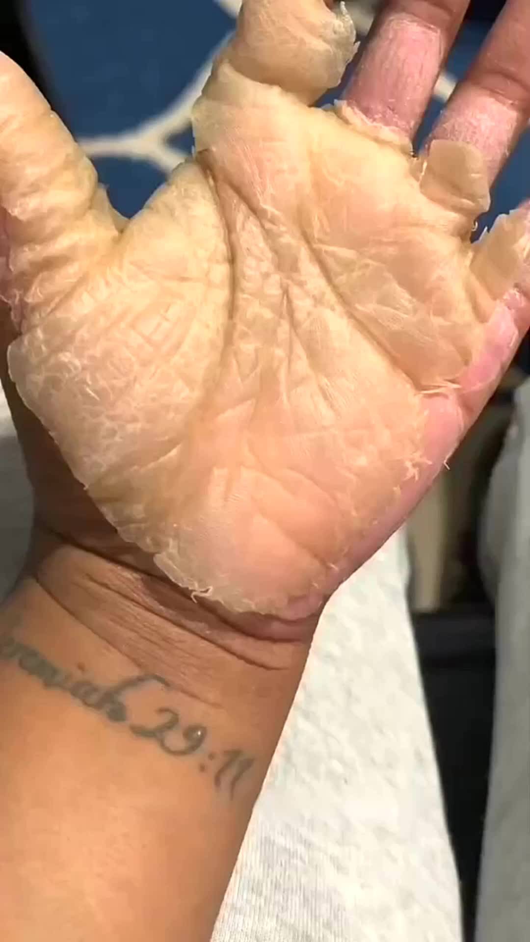 手掌大面积的脱皮怎么造成的?可惜这种病不能痊愈!