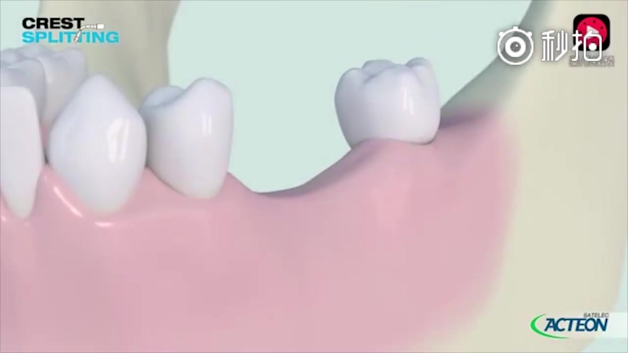 1分钟看懂种植牙手术全过程 【整容】