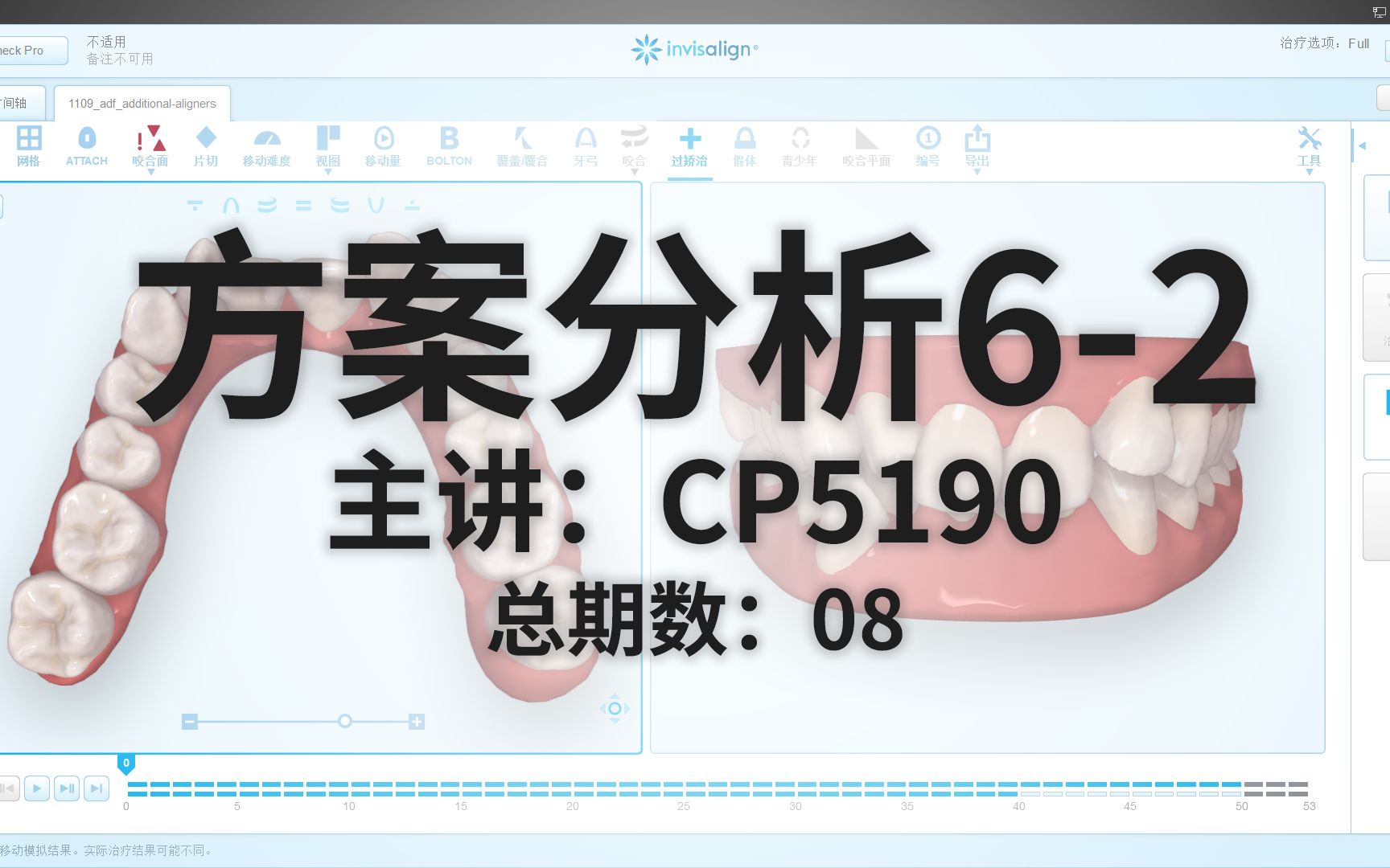 隐形牙套设计,纯正方案分析,干货不放水,3shape Orthoanalyzer操作讲解...