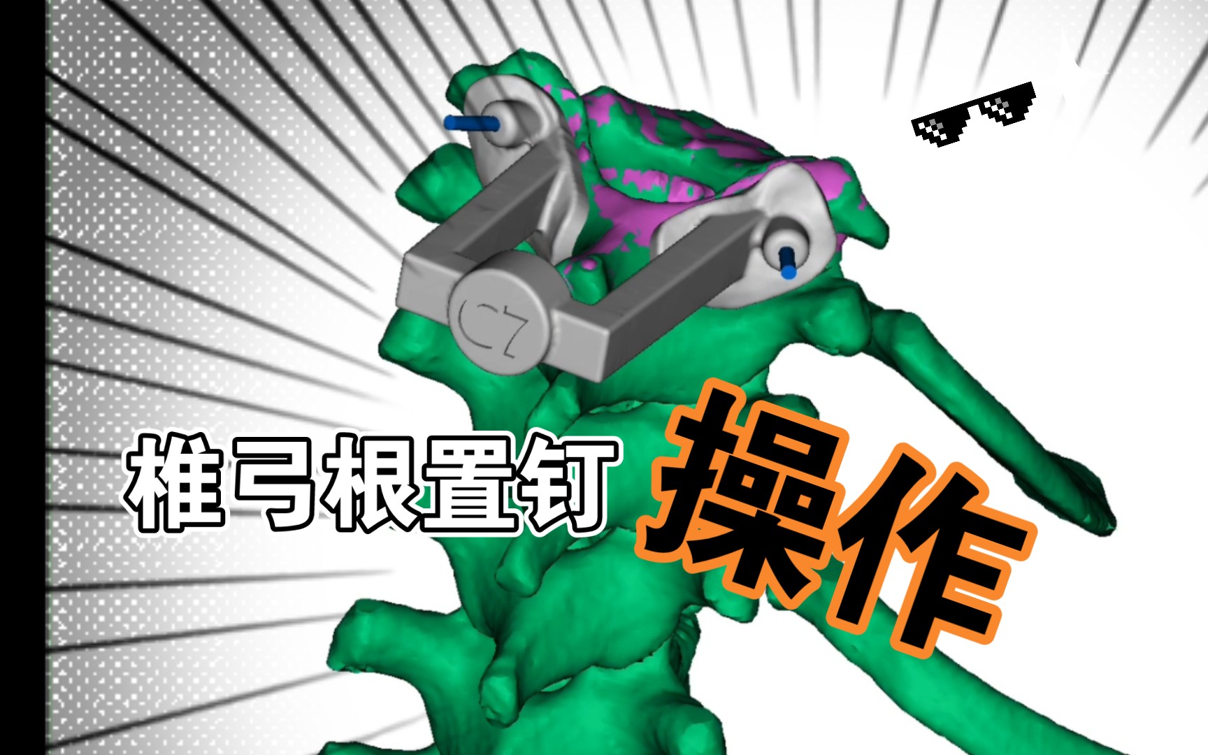 利用Mimics、3-matic等软件制作椎弓根置钉辅助手术工具的方法猜想