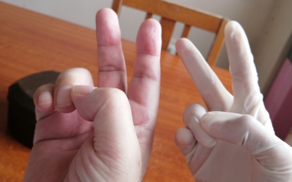 康复治疗师小妙招!抓握差,腕关节背伸差的患者绷带绑法(适用推双棒/...